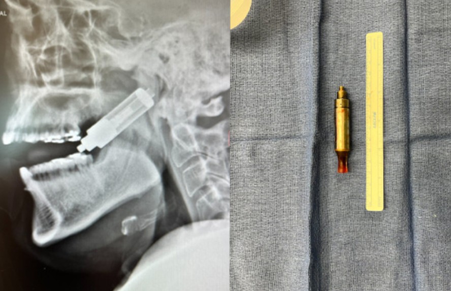 Vape explode e fica alojado em crânio de homem