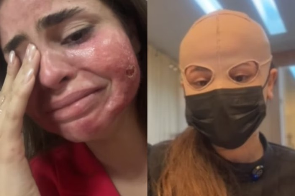 Queimadura após peeling faz médica usar máscara 24h