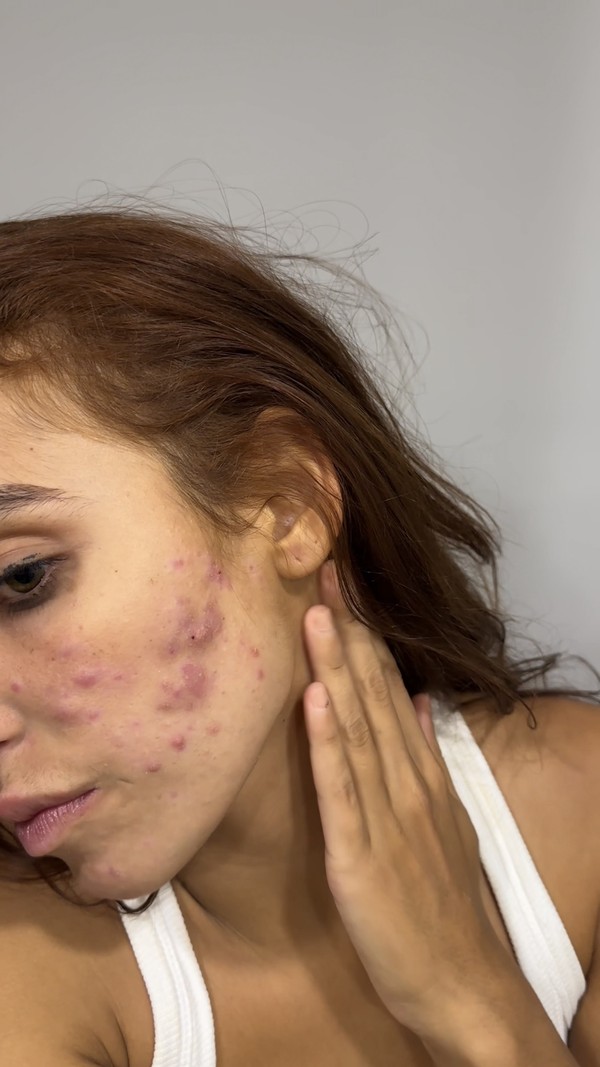 Vanessa Lopes relembra quadro de acne severa: 'A cobrança de estar ...