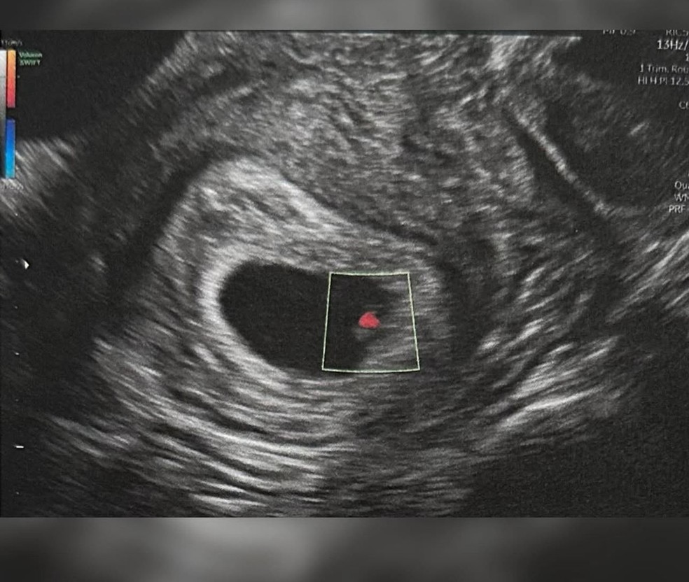 Amanda Djehdian perde bebê que estava esperando: 'Nosso anjinho virou ...