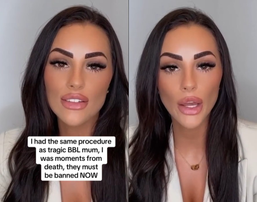 Britânica faz alerta após complicações com BBL: 'Os médicos disseram ...