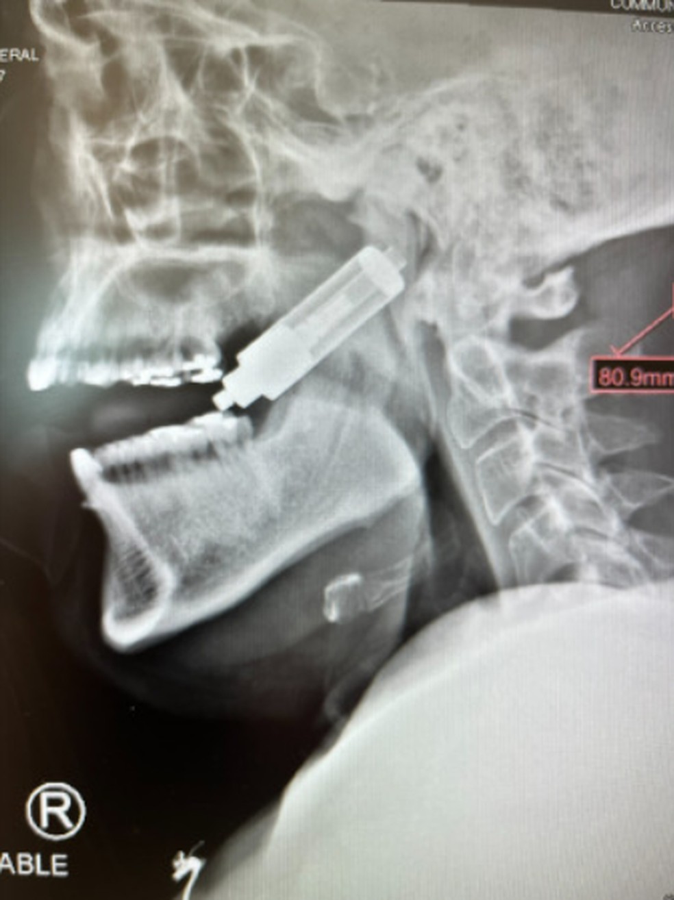 Vape explode e fica alojado em crânio de homem